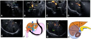 A station-wise approach to liver anatomy for linear EUS