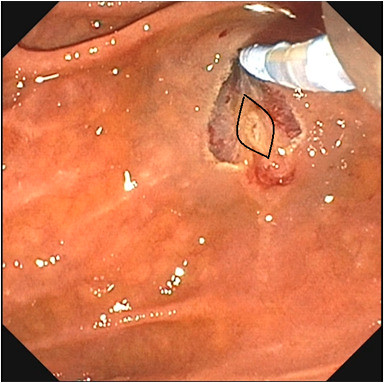 Submucosal injection to facilitate needle-knife sphincterotomy: a novel ...